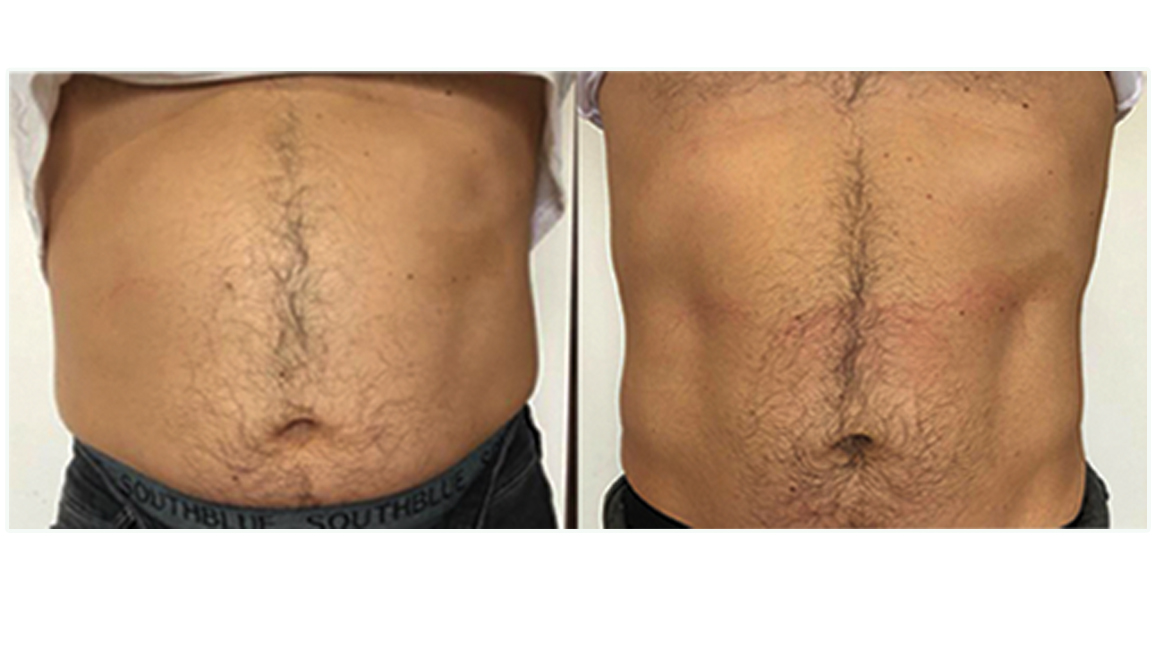 TESLA FormerTM FMS สลายไขมัน สร้างกล้ามเนื้อ กระชับสัดส่วน ฟิตแอนด์ ...