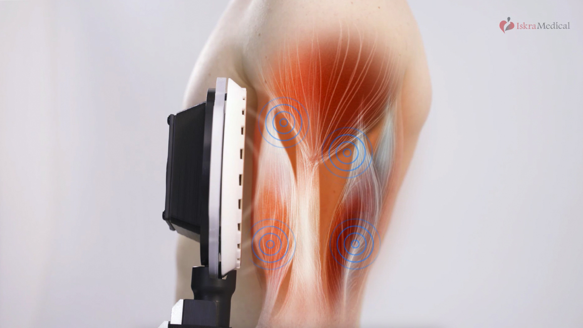 TESLA FormerTM FMS สลายไขมัน สร้างกล้ามเนื้อ กระชับสัดส่วน ฟิตแอนด์ ...