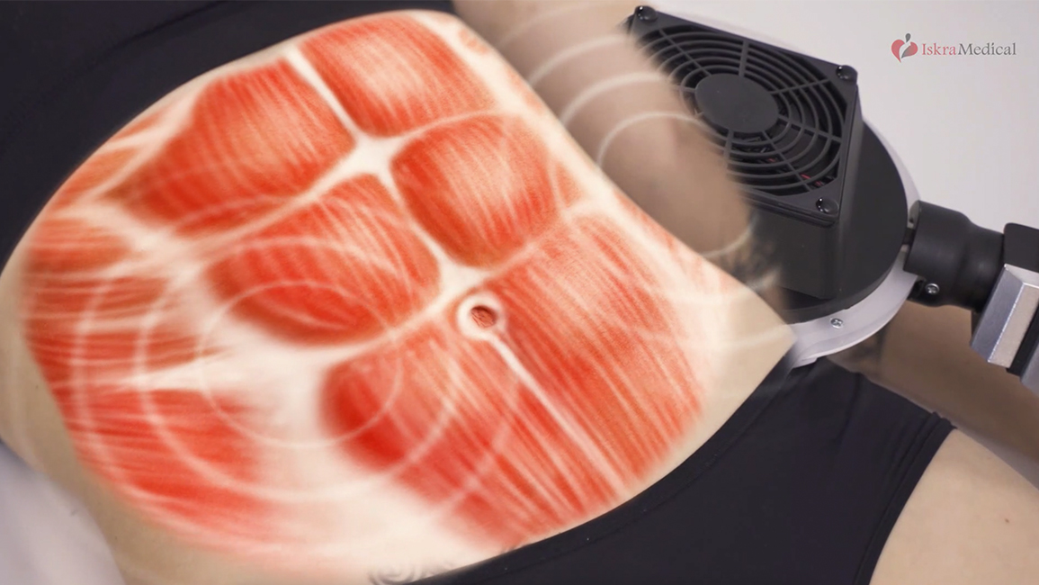 TESLA FormerTM FMS สลายไขมัน สร้างกล้ามเนื้อ กระชับสัดส่วน ฟิตแอนด์ ...